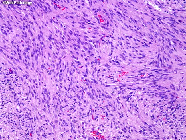 GIST of Low Malignant Potential