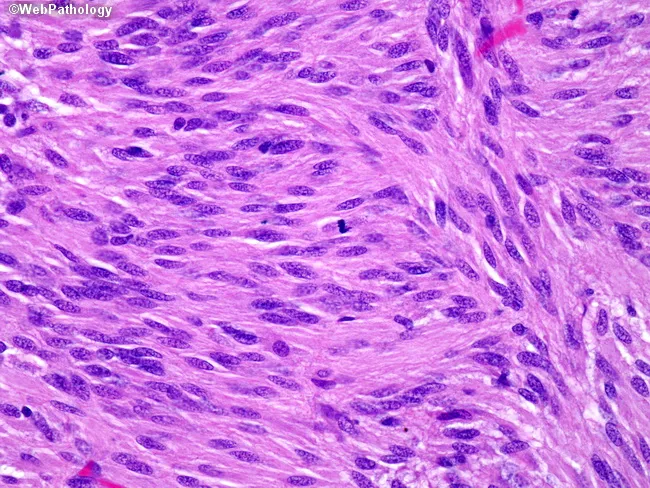 GIST of Low Malignant Potential
