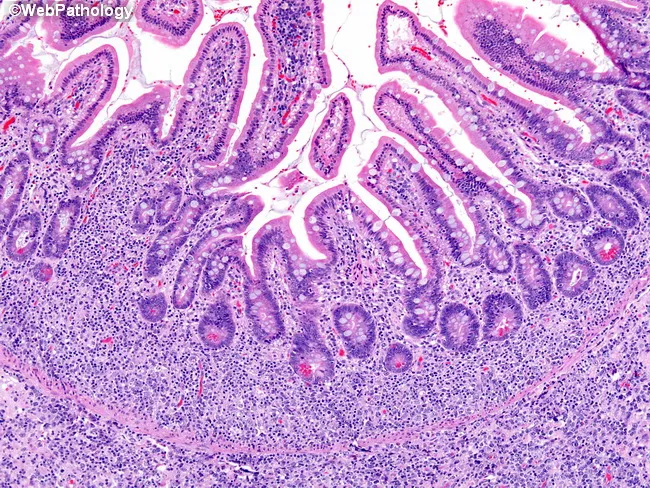Diffuse Large B-cell Lymphoma : Small Bowel
