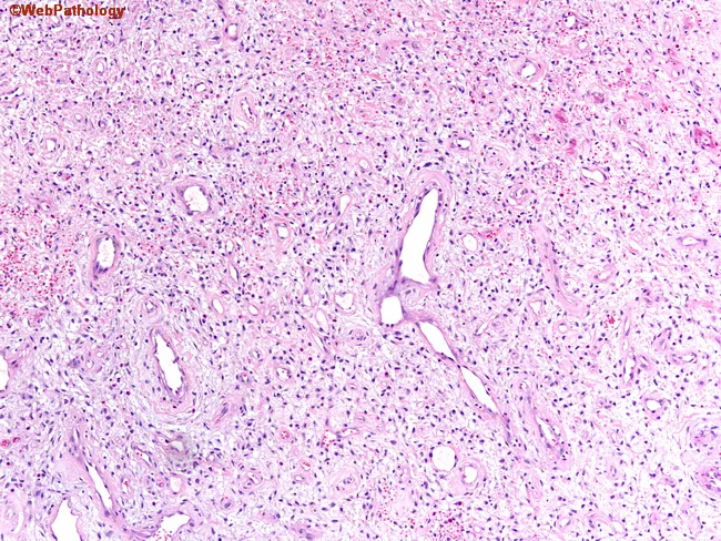 Inflammatory Fibroid Polyp