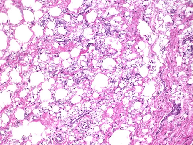 Fat Necrosis : Breast