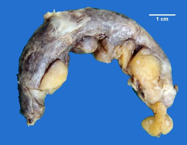 Gangrenous Appendicitis