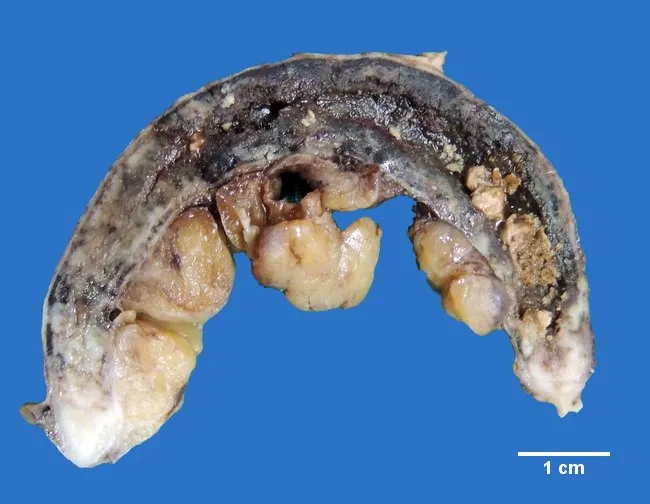 Gangrenous Appendicitis