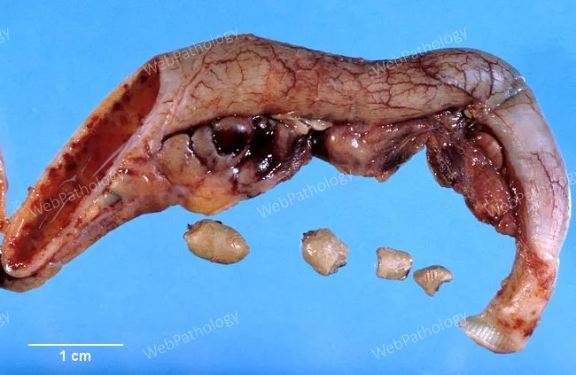 Acute Appendicitis : Fecaliths
