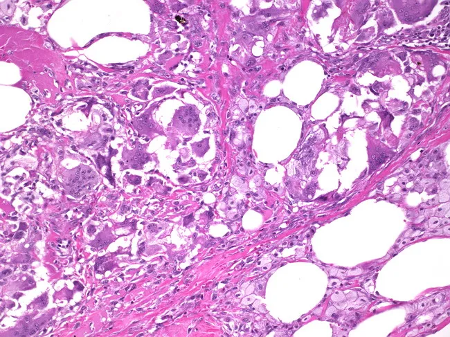 fat necrosis resolution