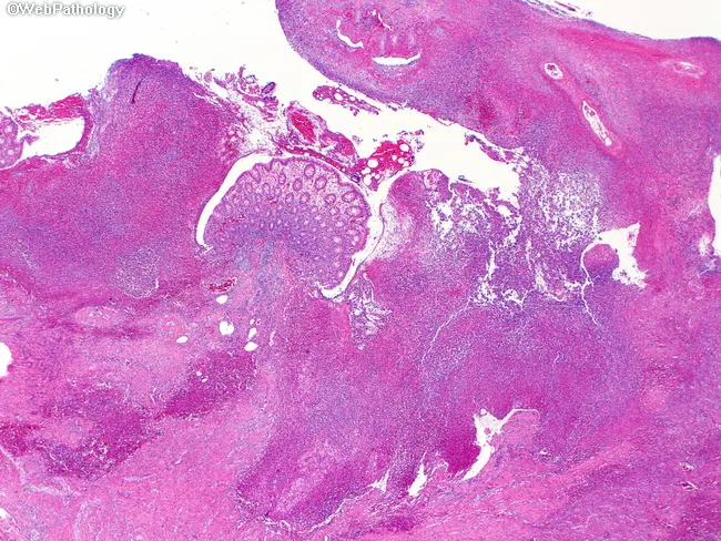 Periappendicular Abscess