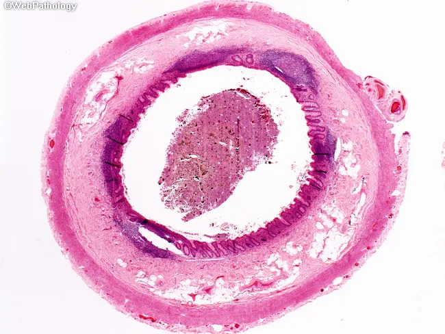 Acute Appendicitis : Fecalith