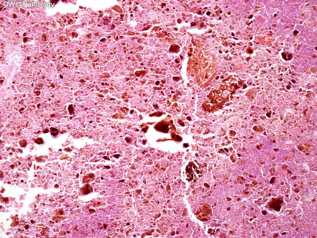 Acute Appendicitis : Fecalith