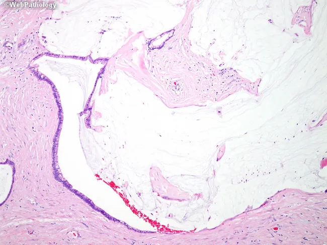 Pseudomyxoma Peritonei Case 1