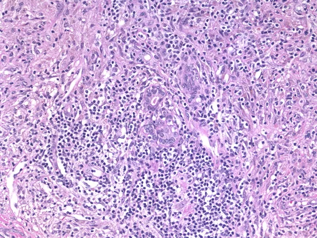 Granulomatous mastitis