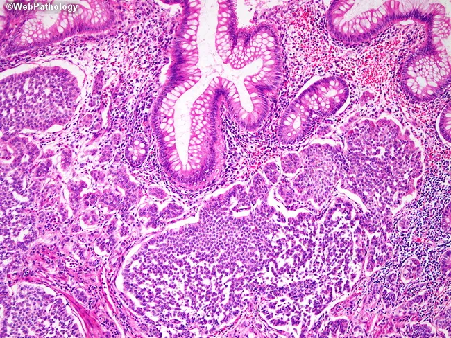 Carcinoid Tumor