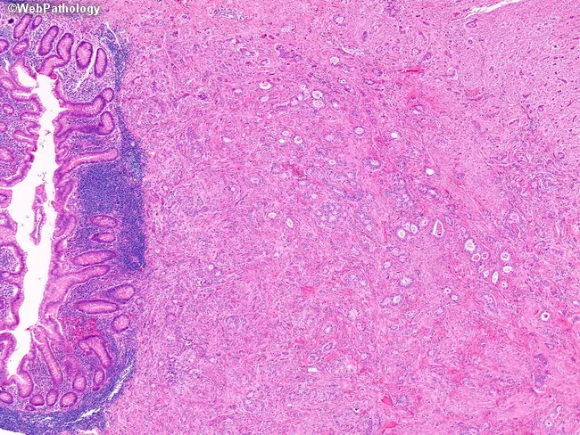 Carcinoid Tumor Adenocarcinoid Type