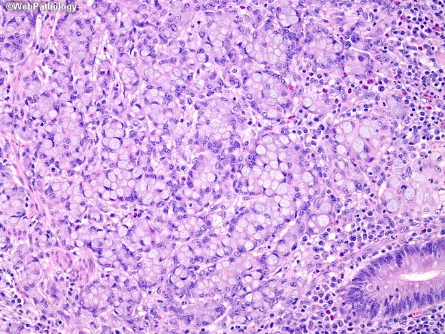 Goblet Cell Carcinoid, Group B
