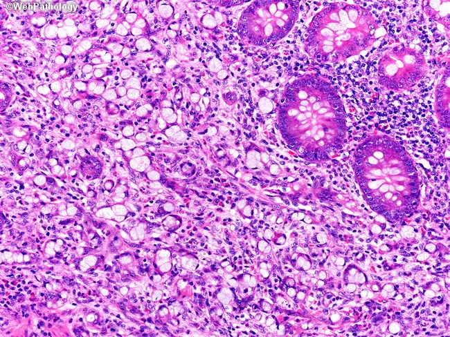 Goblet Cell Carcinoid, Group B