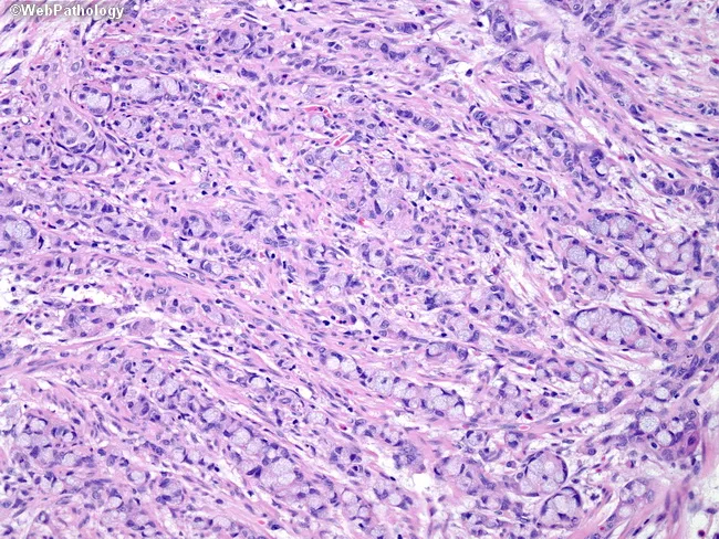 Goblet Cell Carcinoid, Group B