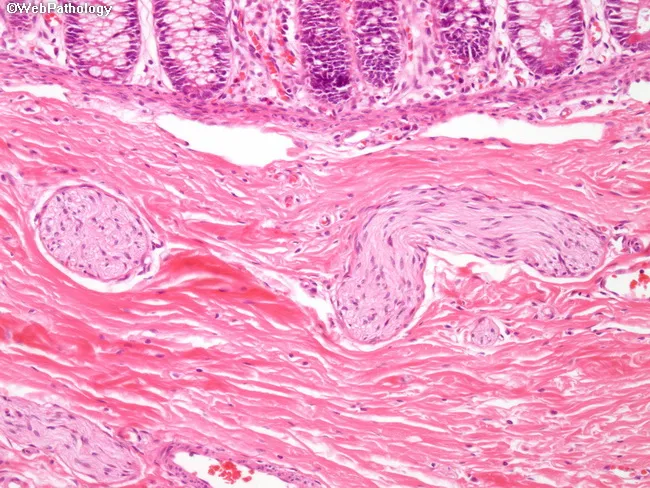 Hirschsprung Disease : Pathogenesis