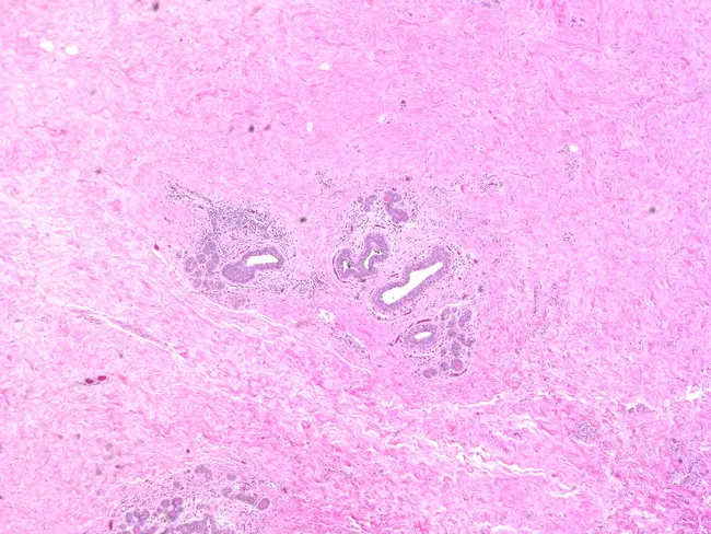 Lymphocytic Mastitis (Diabetic Mastopathy)