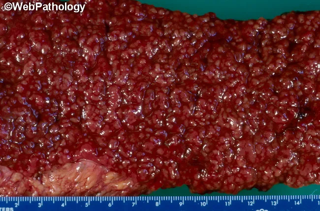 Ulcerative Colitis : Gross Pathology