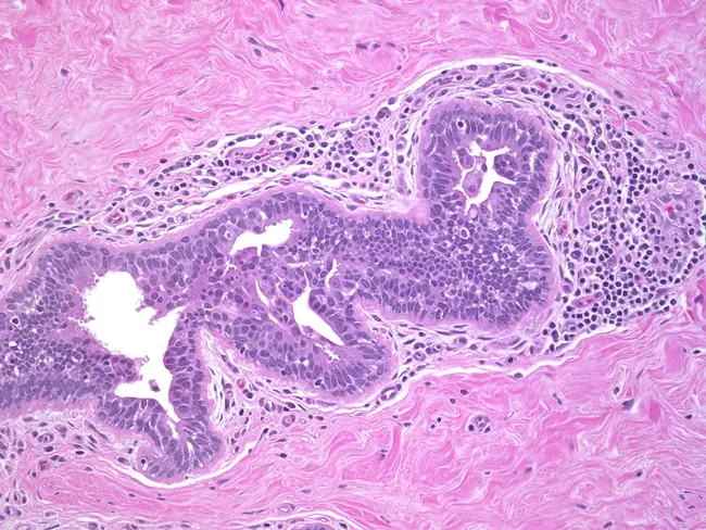 Lymphocytic Mastitis (Diabetic Mastopathy)