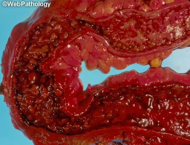 Ulcerative Colitis : Gross Pathology