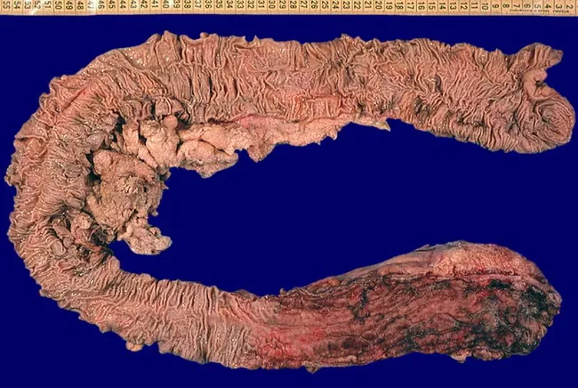 Ulcerative Proctitis
