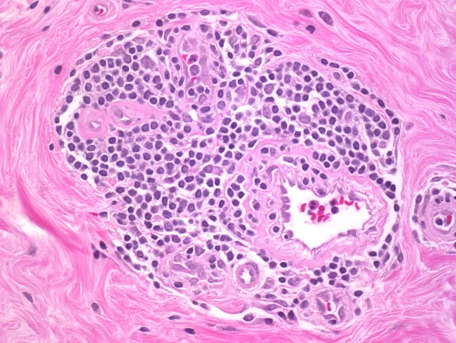 Lymphocytic Mastitis (Diabetic Mastopathy)
