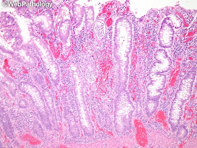 Ulcerative Colitis : Differential Diagnosis