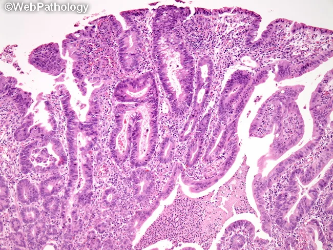 Dysplasia in Ulcerative Colitis