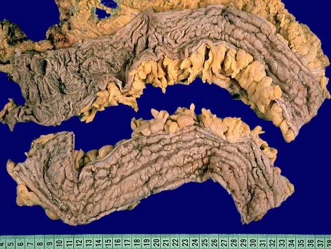 Crohn Disease : Gross Pathology