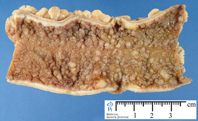 Crohn Disease : Gross Pathology