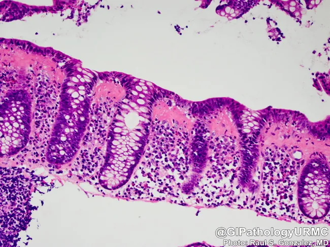 Collagenous Colitis Clinical