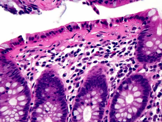Collagenous Colitis : Microscopic