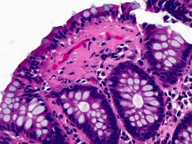 Collagenous Colitis : Microscopic