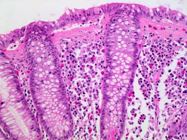 Collagenous Colitis : Microscopic