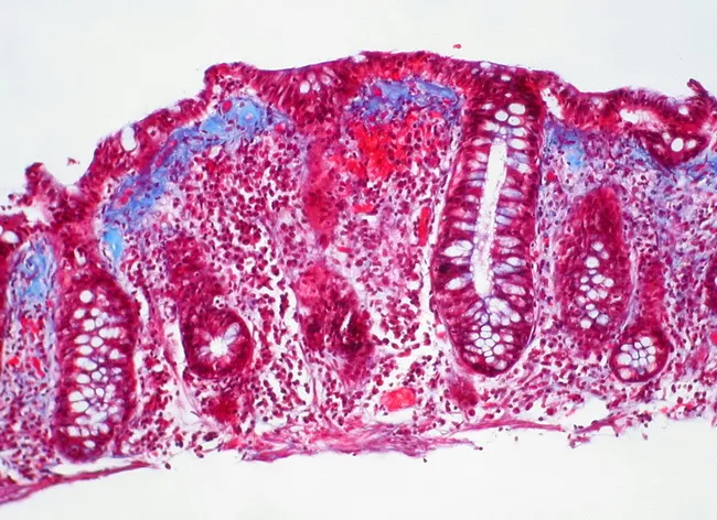 Collagenous Colitis : Trichrome