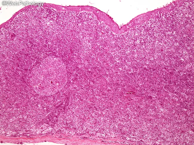Branchial Cleft Cyst