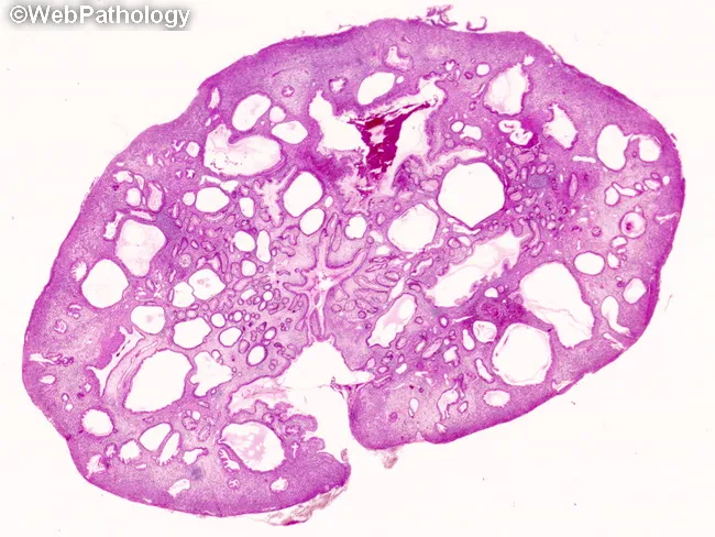 Juvenile Polyp : Microscopic