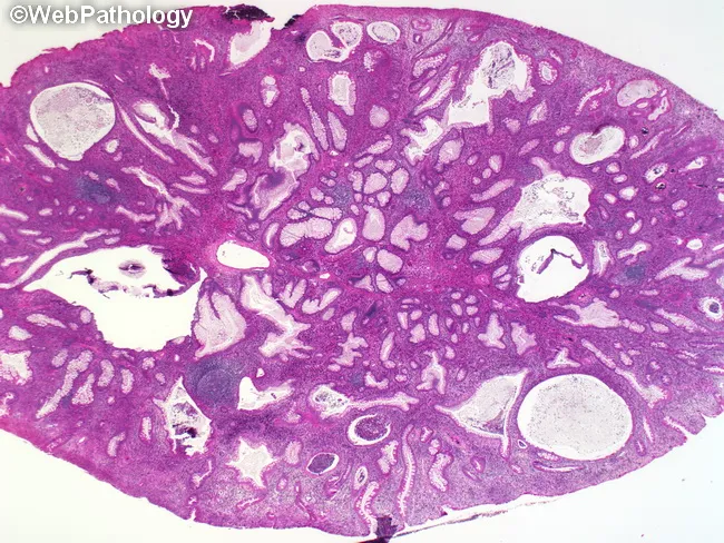 Juvenile Polyp : Microscopic