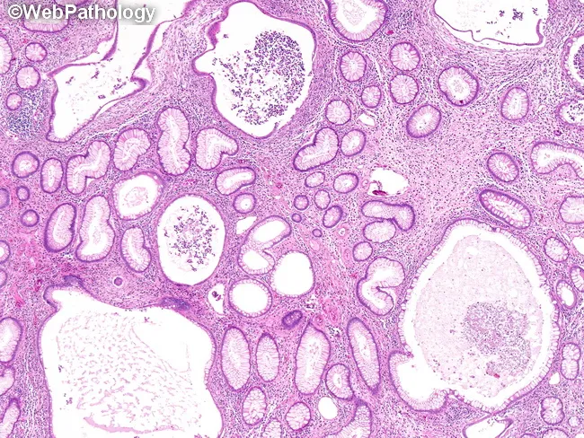 Juvenile Polyps Colon Juvenile Polyposis Diagnosed With An Integrated