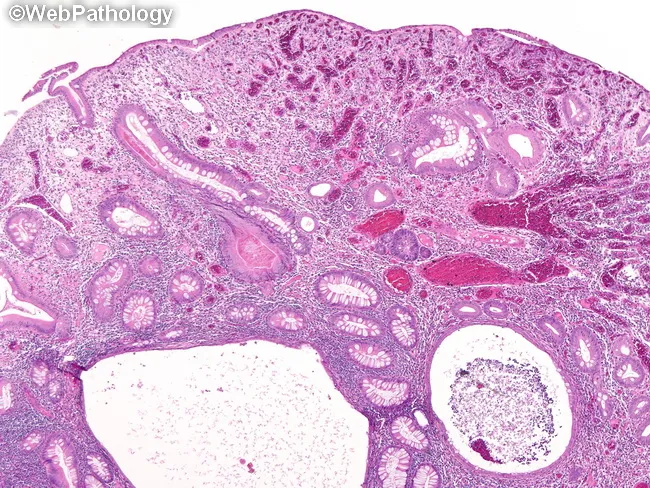 Juvenile Polyp : Microscopic