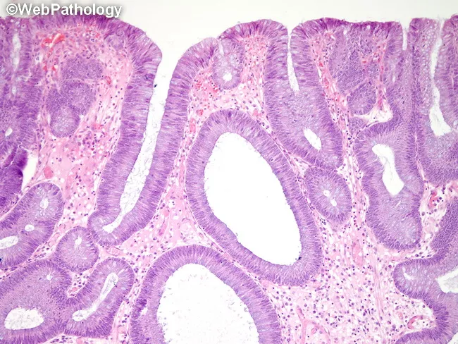 Juvenile Polyp with Dysplasia