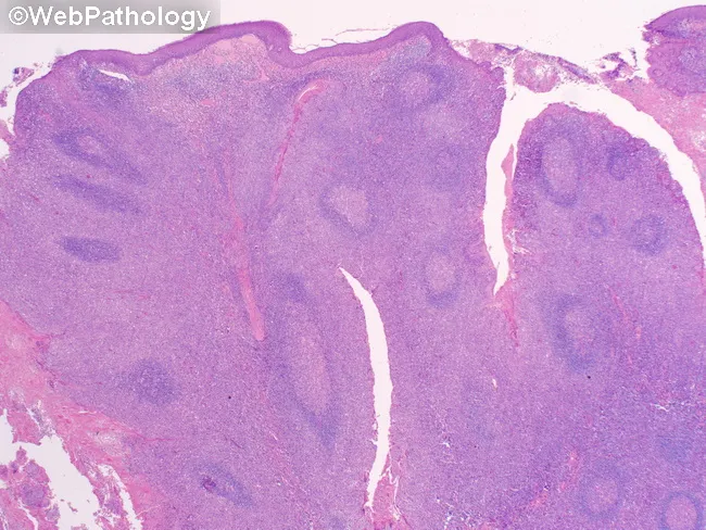 Infectious Mononucleosis - Tonsils