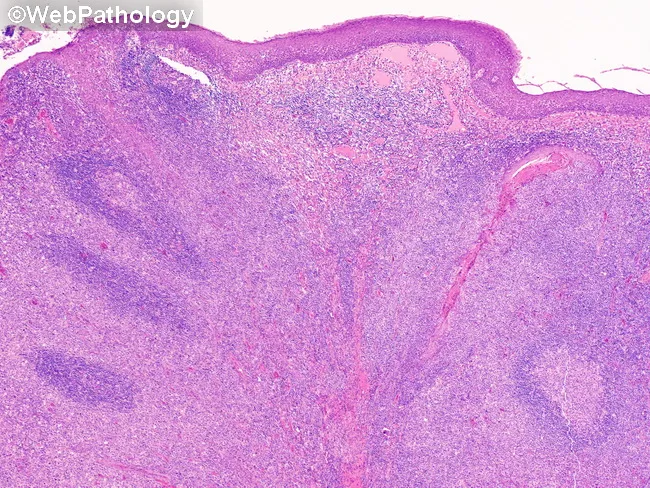 Infectious Mononucleosis - Tonsils