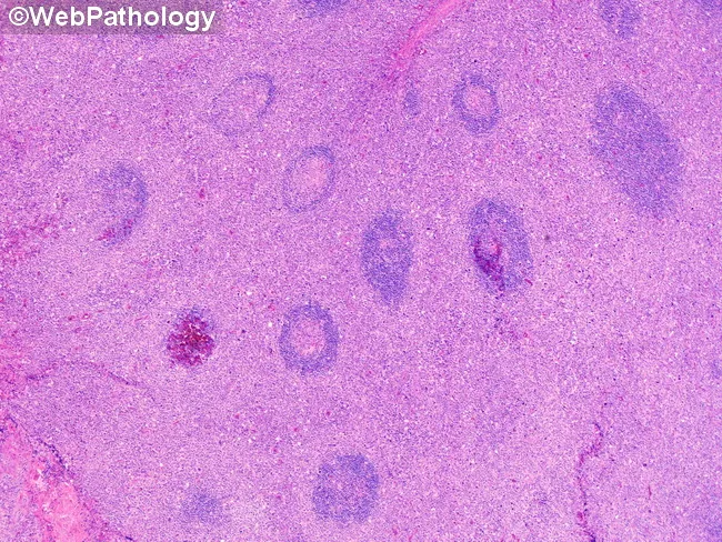 Infectious Mononucleosis - Tonsils