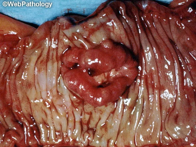 polyps in bowel