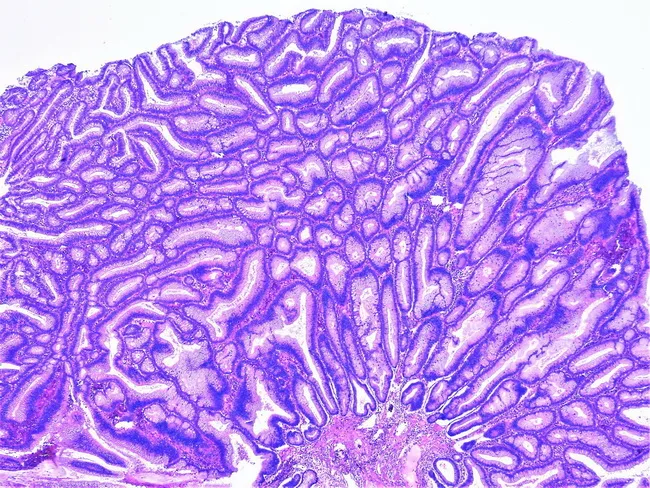 Tubular Adenoma : Histology