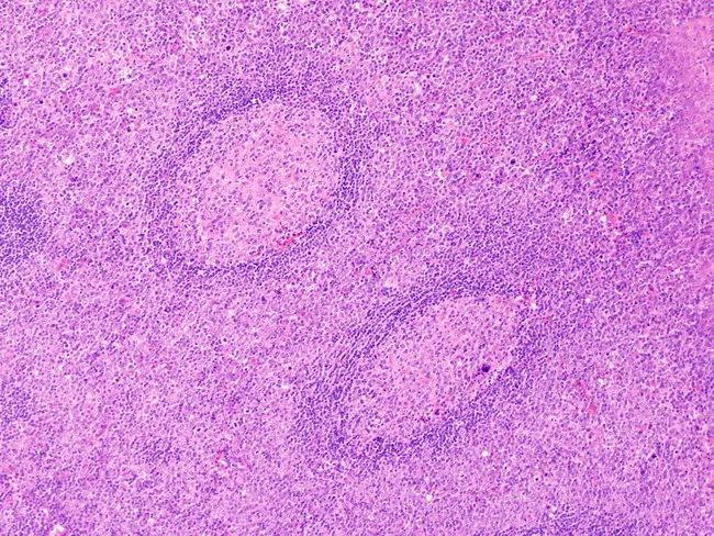 Infectious Mononucleosis - Tonsils