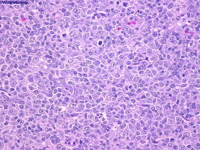 Infectious Mononucleosis - Tonsils