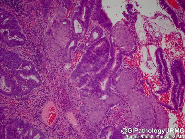 Tubular Adenoma : Squamous Morules