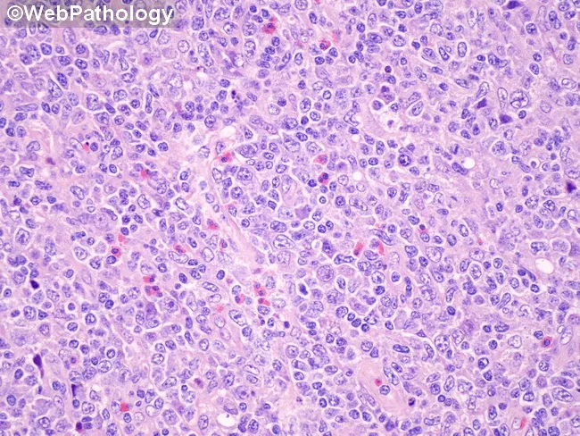 Infectious Mononucleosis - Tonsils